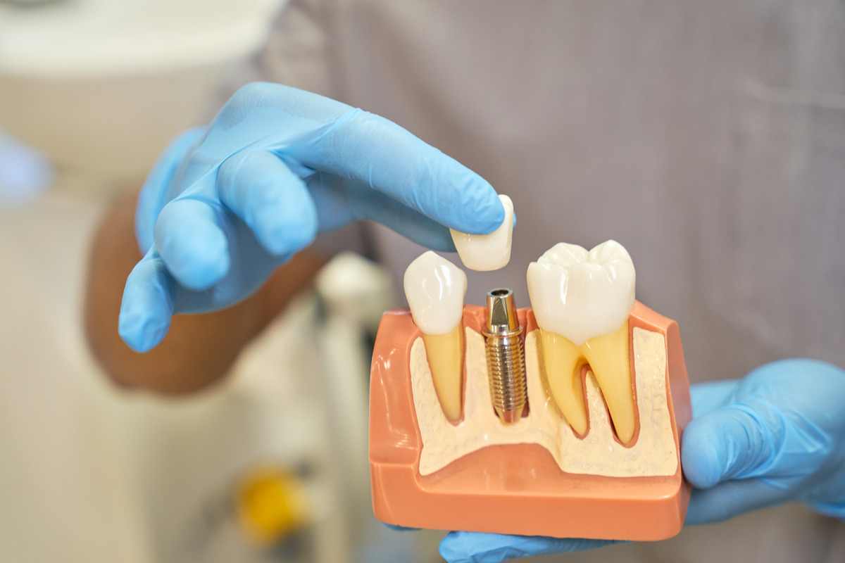 Teeth Implant Steps Explained: What to Expect at Every Stage - Manti ...